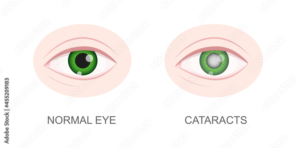 Healthy and cataract eye closeup view. Eyeball with normal and cloudy ...