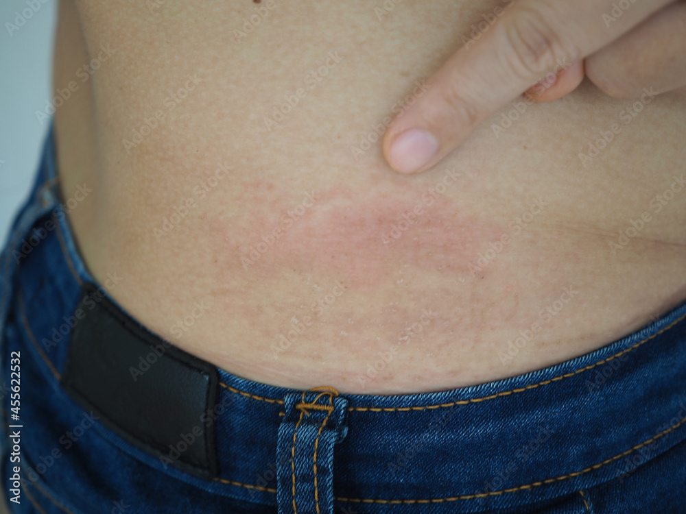 Woman with itchy urticaria or allergic skin reactions. red rash on ...