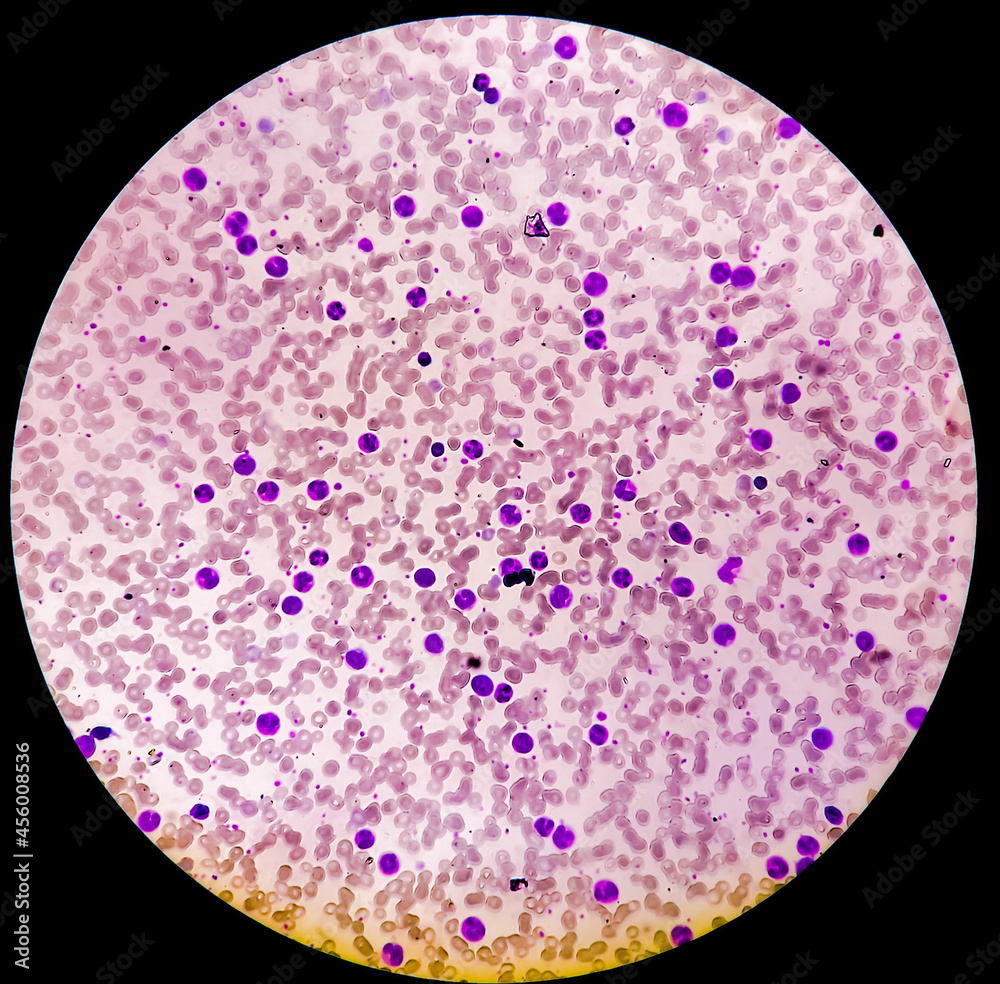 Chronic myeloid leukemia (CML) with chronic phase. Red blood cell ...