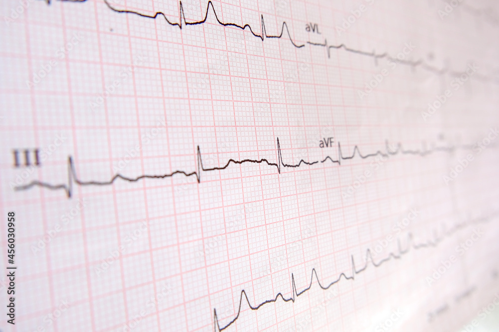 ECG or EKG graph printout showing a patient's heart rhythm and ...