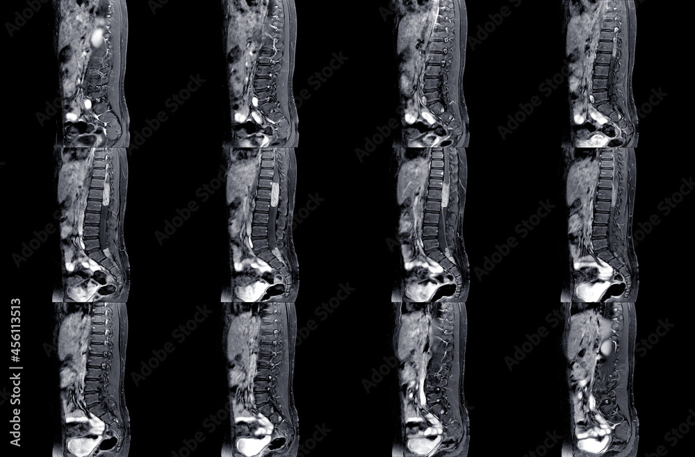 MRI spine showing mass at distal cord and conus medullaris, with tumor ...