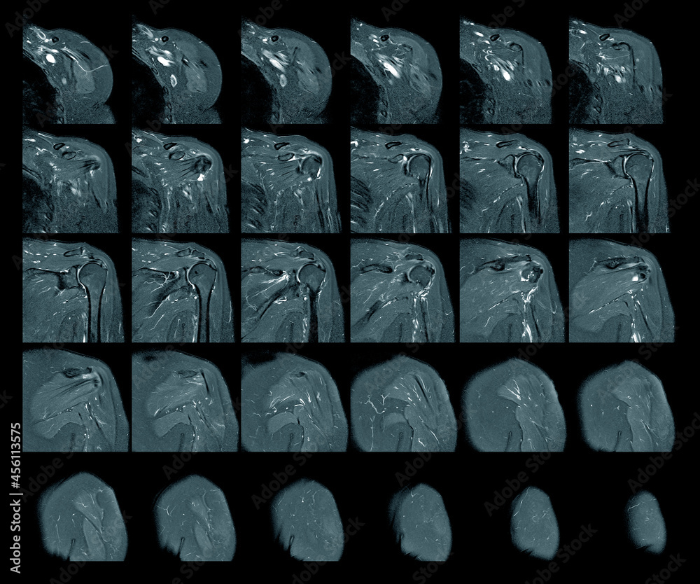 Magnetic Resonance Imaging Of Left Shoulder Rotator Cuff Tear With