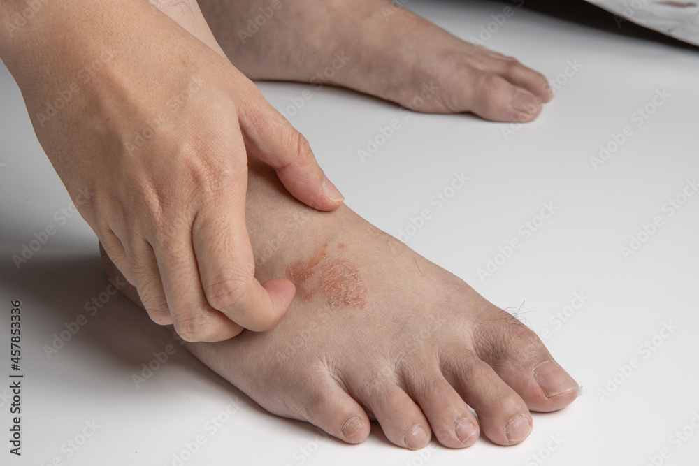 hand scratching foot infected by ringworm, athlete's foot or tinea ...