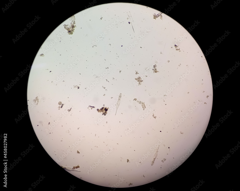 Schistosoma Haematobium Parasite in human urine specimen under ...