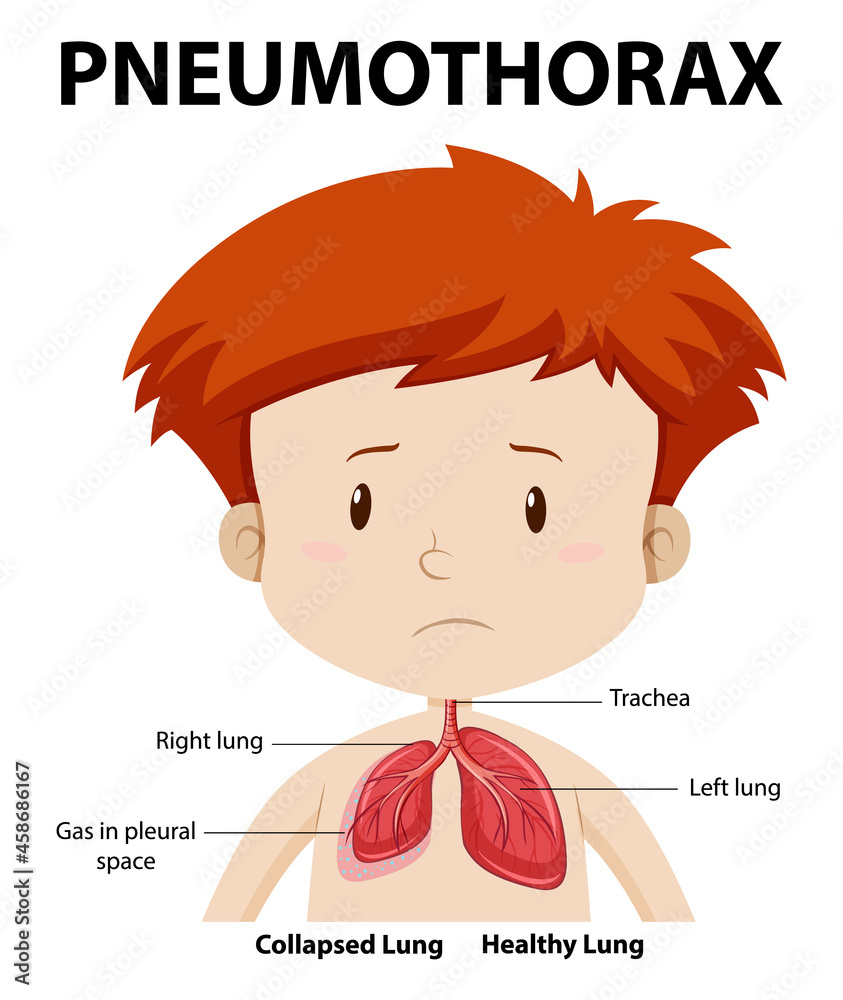 Pneumothorax diagram of human anatomy Stock Vector | Adobe Stock