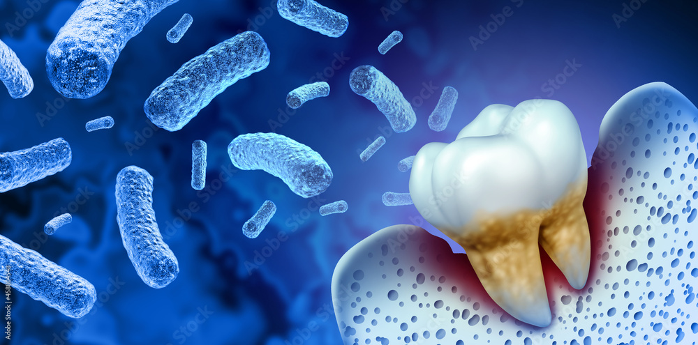 Tooth Bacterial Infection Stock Illustration | Adobe Stock