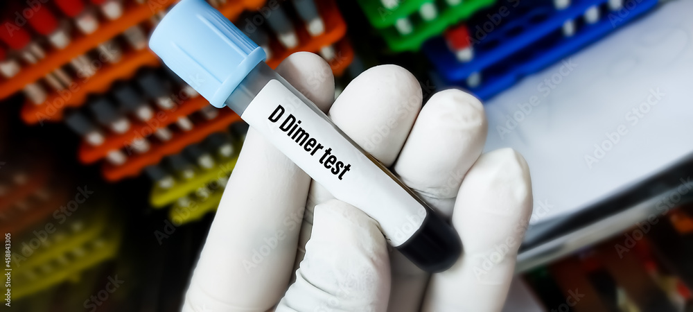 D-Dimer test. Corona patient monitoring test in ICU. Doctor or ...