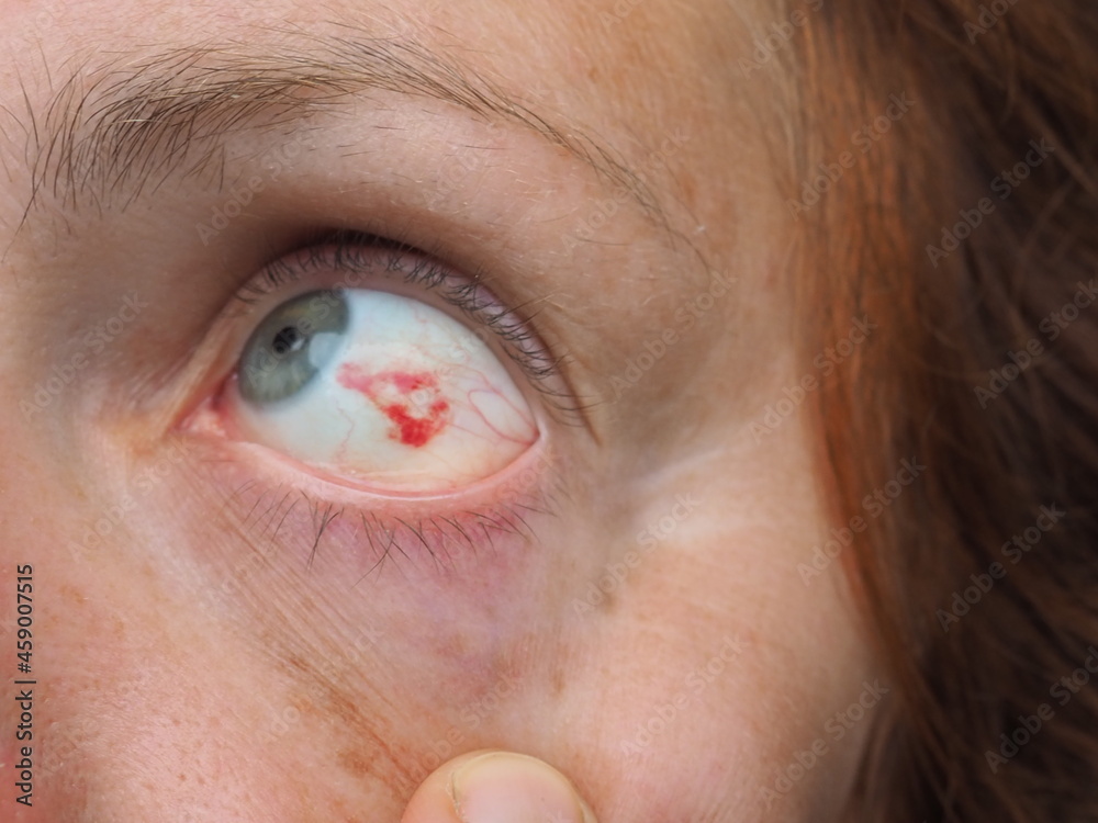 Foto de Stock Subconjunctival hemorrhage or subconjunctival bleeding ...