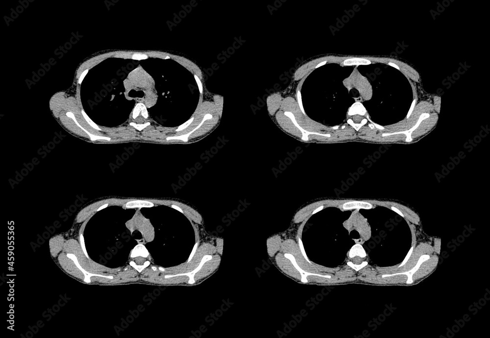 Ct scan and MRI chest unique professional images Stock Photo | Adobe Stock