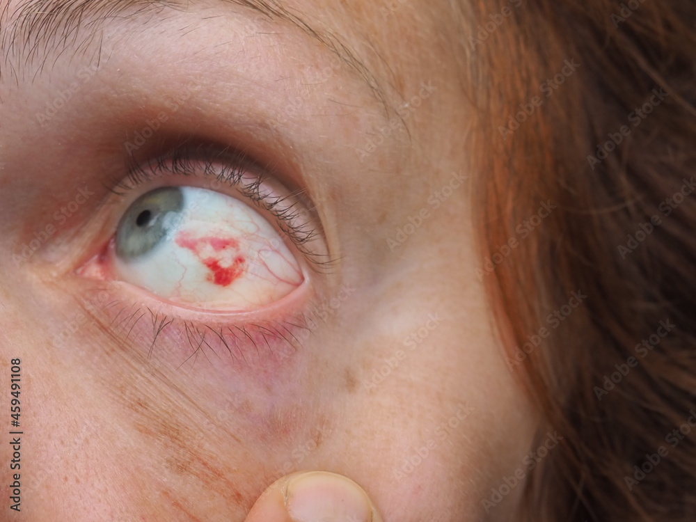 Foto de Stock Subconjunctival hemorrhage or subconjunctival bleeding ...
