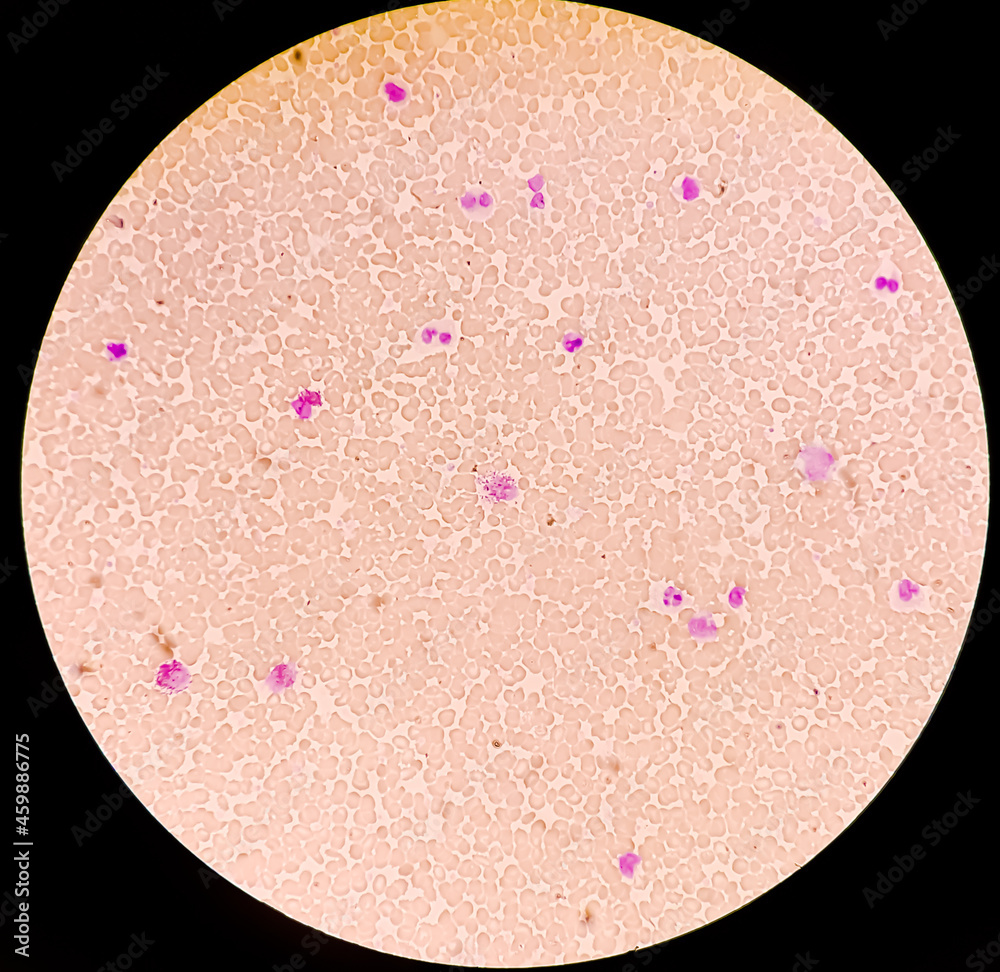 Pancytosis, blood smear showing clumps or high volume of platelet and ...