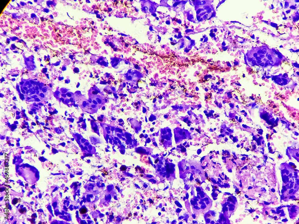 Osteoclast like giant cells. Light micrograph of a giant cell tumour of ...