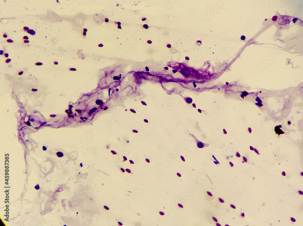 Cytopathology Tissue form breast, microscopic image of granulomatous ...
