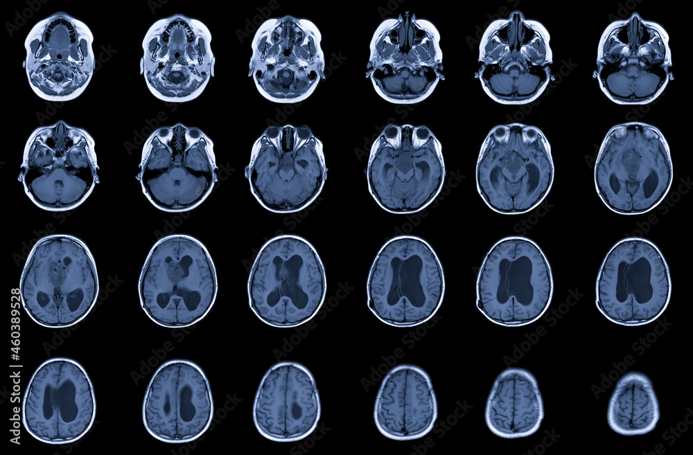 MRI Brain FINDINGS: There is a 3.5cm diameter lobulated mass at ...