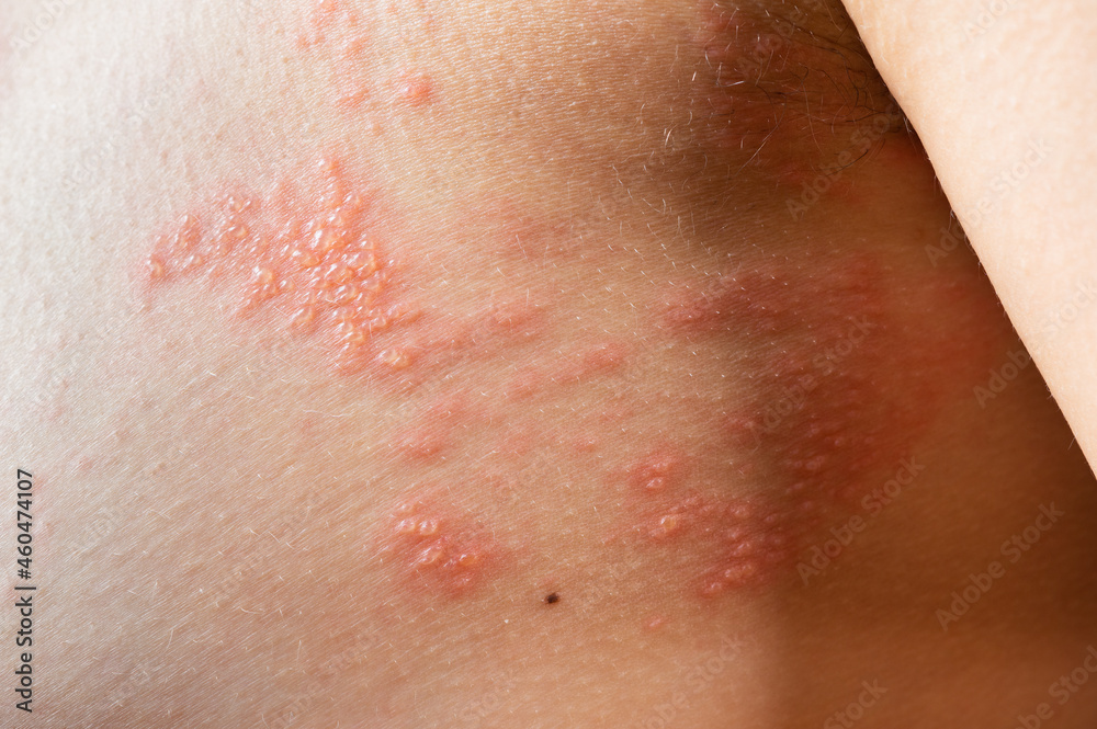 chickenpox rash. Shingles, varicella-zoster virus. skin rash and ...