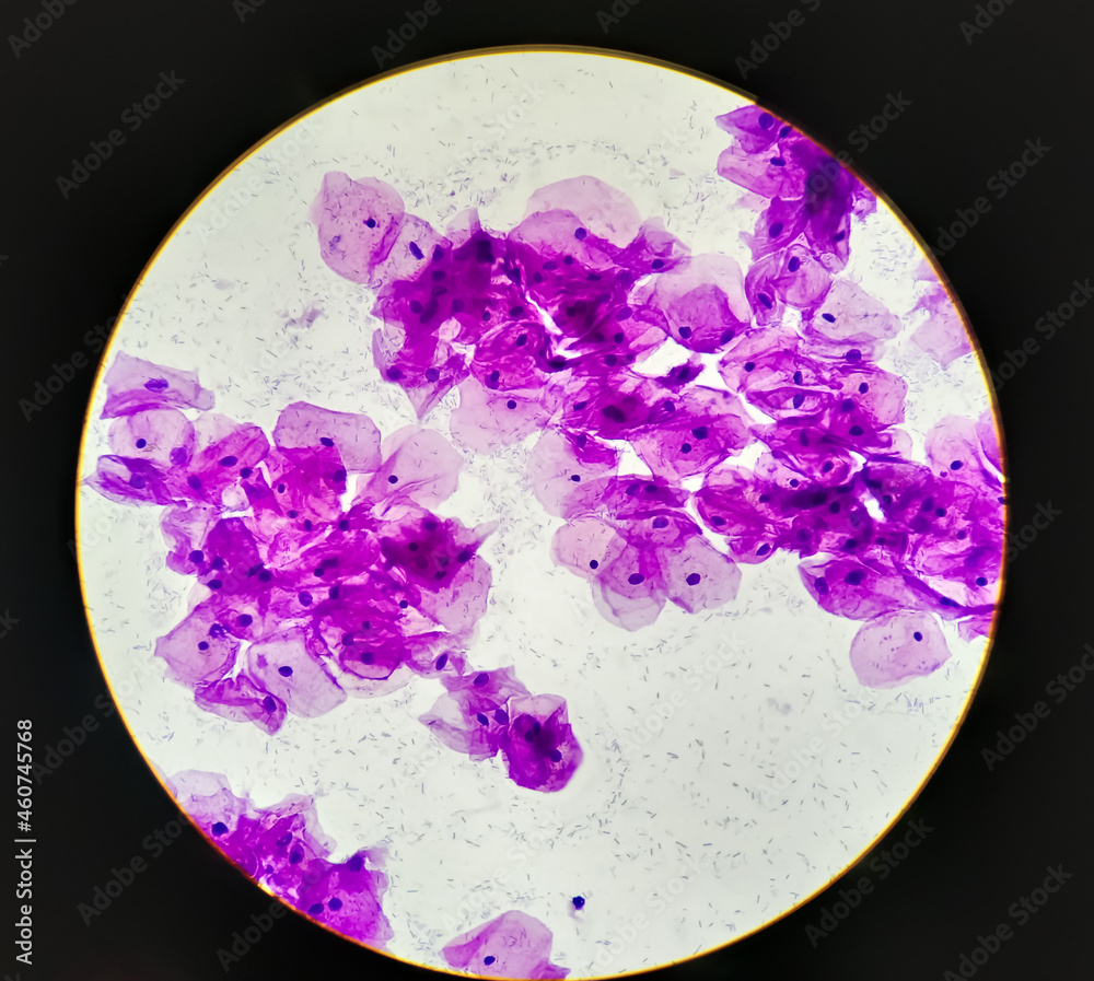 Pap's smear Cytology microscopic 100x show normal human cervix cells ...