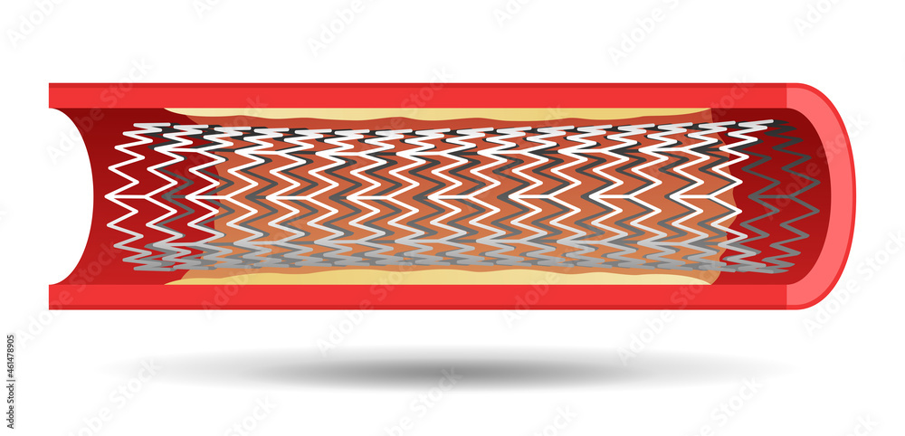 Coronary stent implant in blood vessel Stock Vector | Adobe Stock