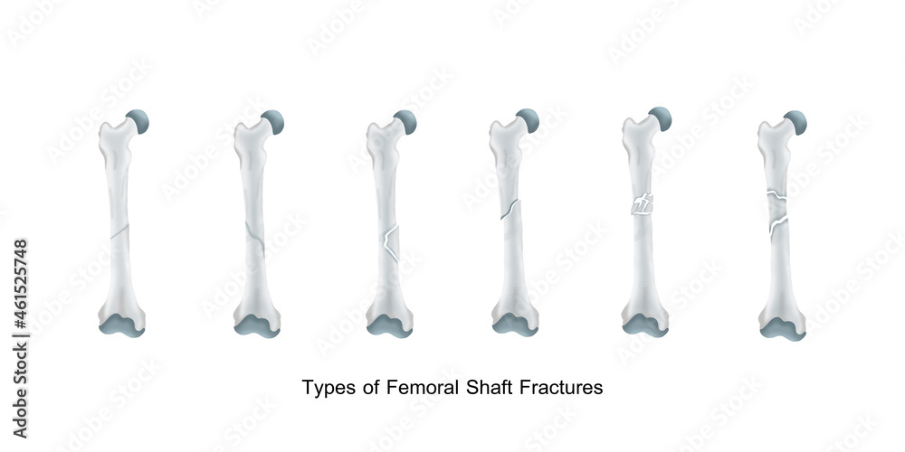 Types of Femoral Shaft Fractures Stock Vector | Adobe Stock