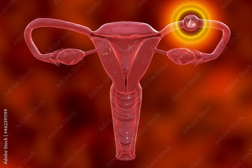 Tubal ectopic pregnancy, 3D illustration Stock Illustration | Adobe Stock
