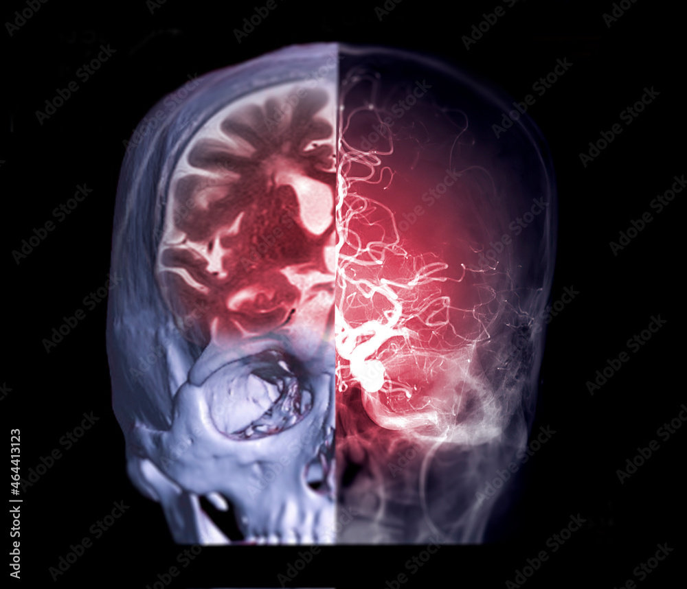 Fusion image of CT MRI brain and Cerebral angiography image front view ...