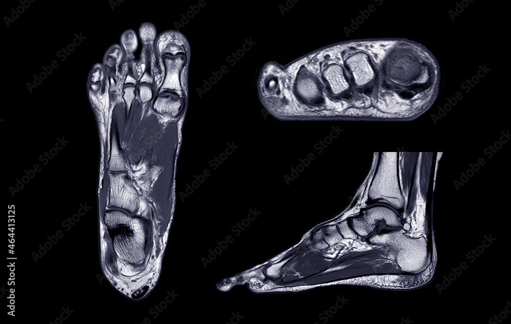 Manetic resonance imaging of foot or MRI FOOT PDW axial, Coronal and ...