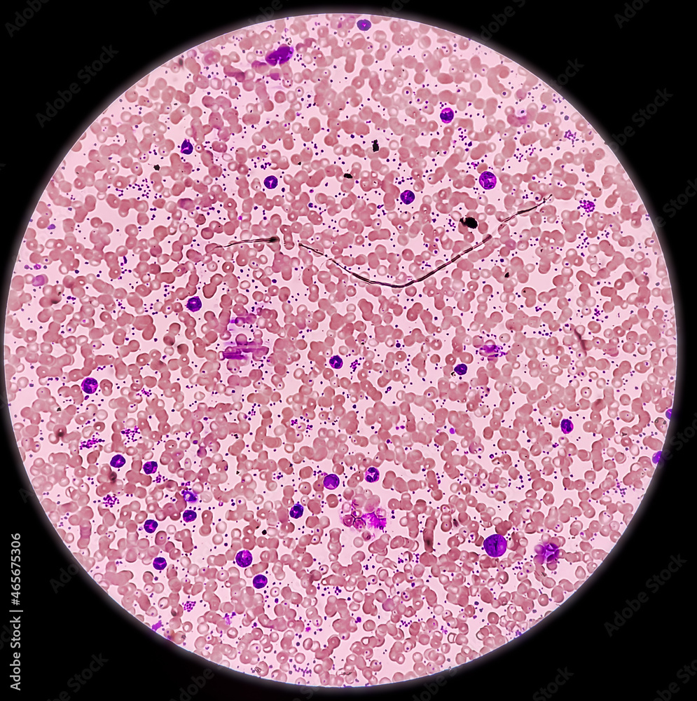 Thrombocythemia, Essential thrombocytosis blood smear, present abnormal ...
