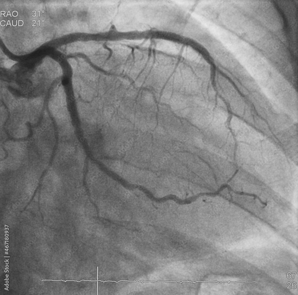 Coronary angiogram (CAG) was performed successful percutaneous coronary ...