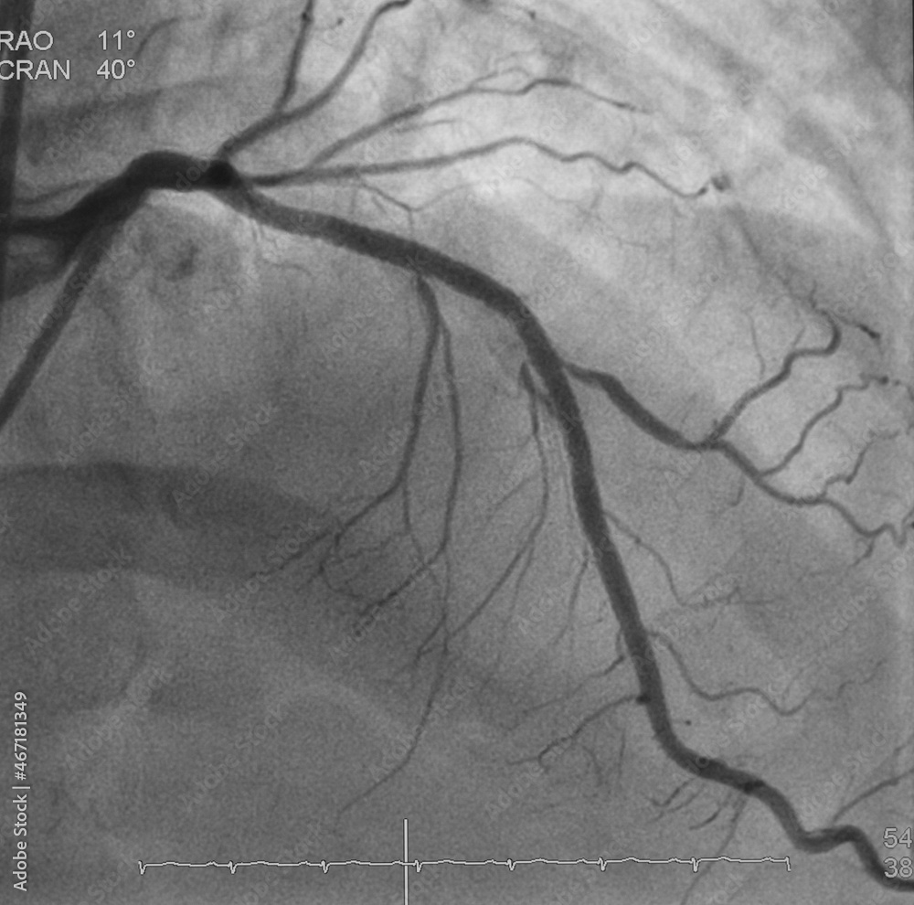 Coronary angiogram (CAG) was performed successful percutaneous coronary ...