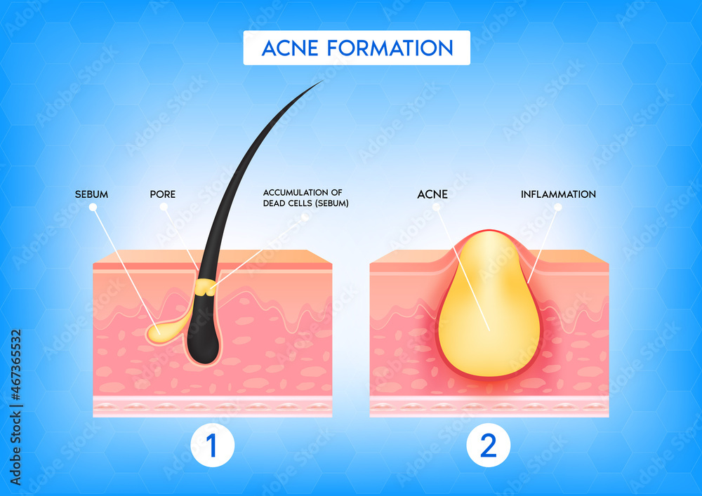 Sebum acne store