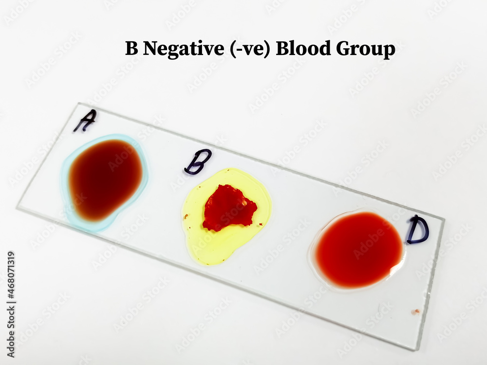 Blood group and Rh factor testing by slide agglutination method. Blood ...