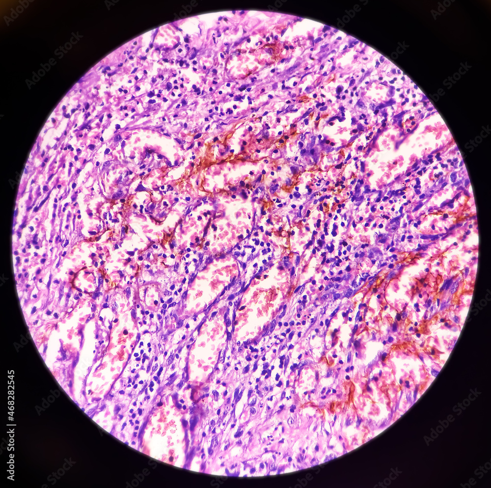 Microscopic image of chronic epididymo-orchitis in testis tissues ...
