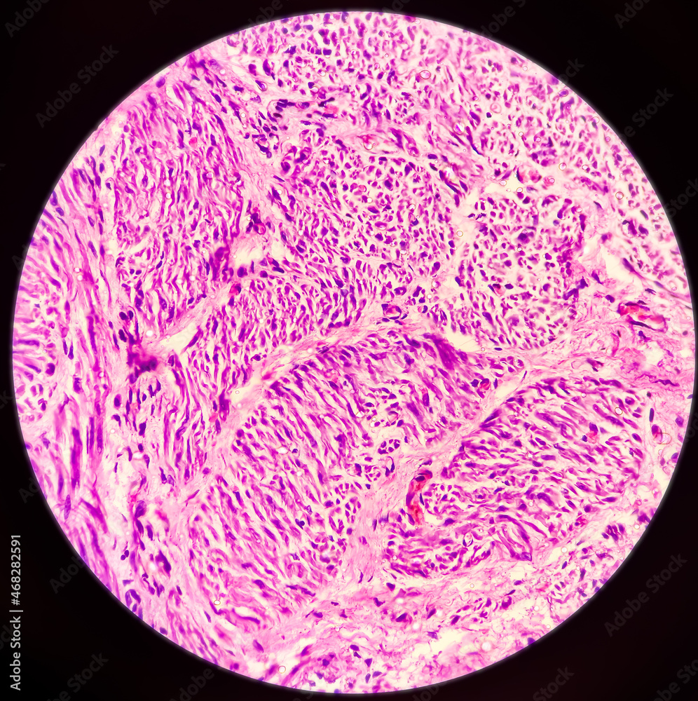 Foto de Stock Microscopic image of chronic epididymo-orchitis in testis ...
