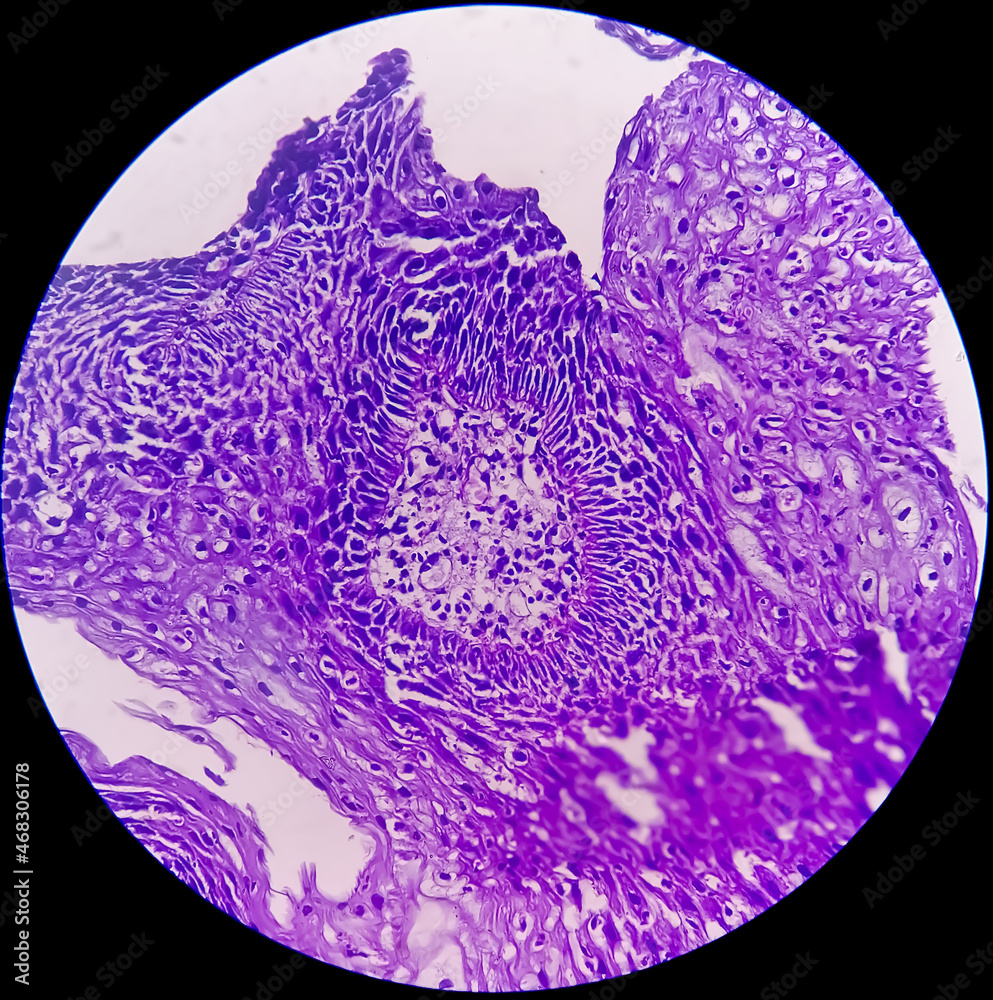 Colon Cancer: Photomicrograph (microscopic image) of an invasive ...
