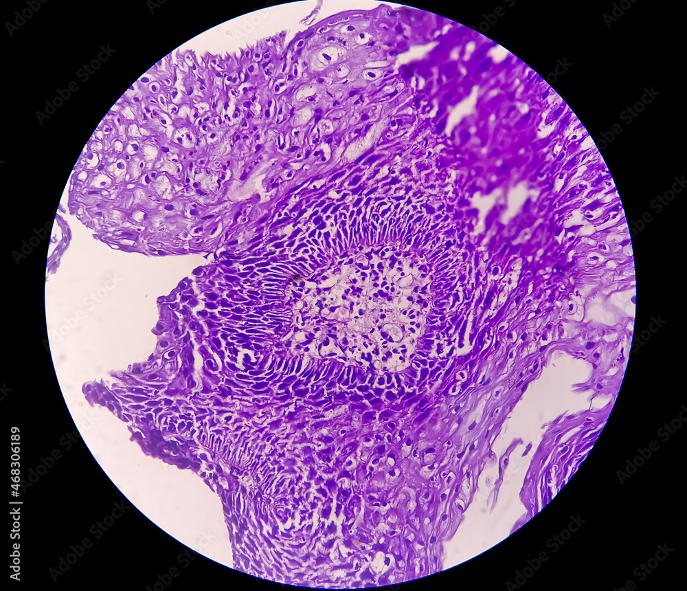 Colon Cancer: Photomicrograph (microscopic image) of an invasive ...
