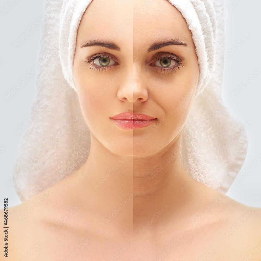 Plastic Surgery Results,Nasolabial folds,Neck ,Under eye circles,neck ...