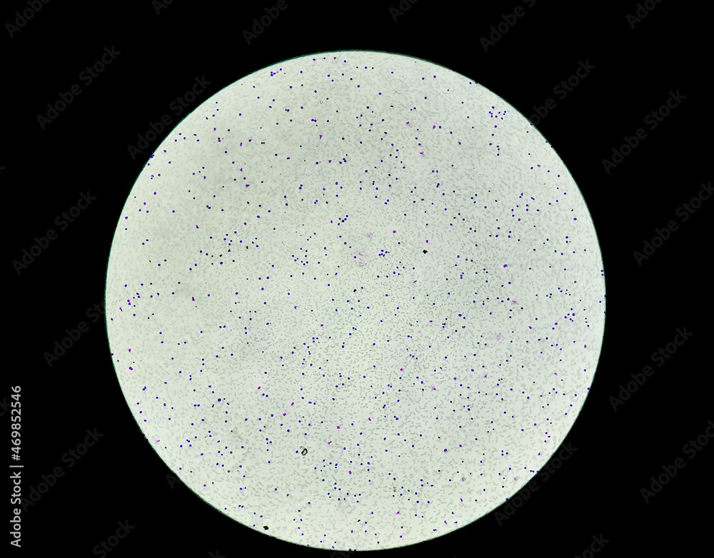 Blood smear leishman stained Microscopic 10x show Acute lymphocytic ...