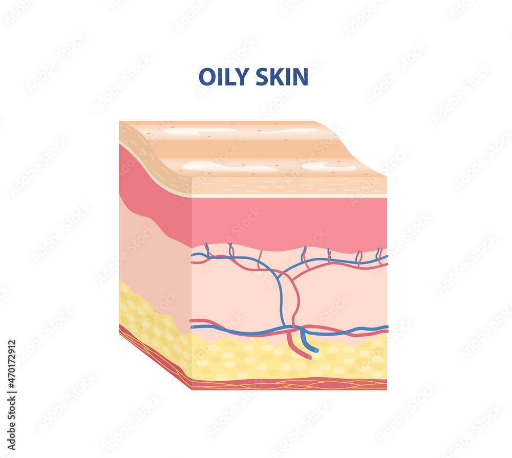 Skin Type Sticker. Colorful icon with layers of skin. Oily epidermis ...