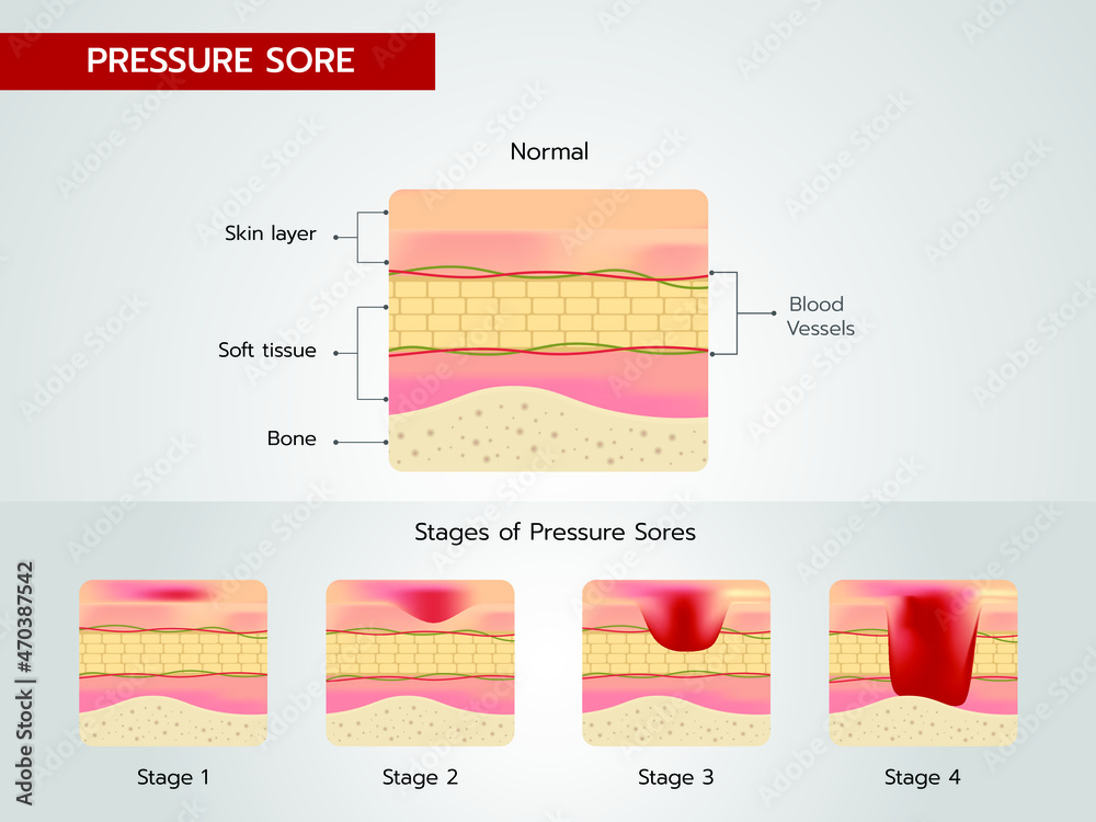 Bedsores Pressure Ulcers Stages of Pressure Sores Stock Vector | Adobe ...
