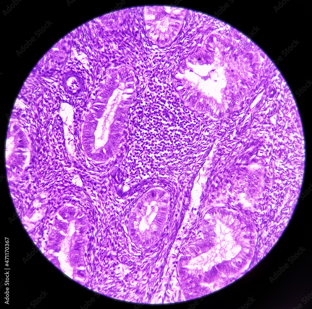 Stock-Foto „Uterus: Chronic cervicitis with CIN-1, under light ...