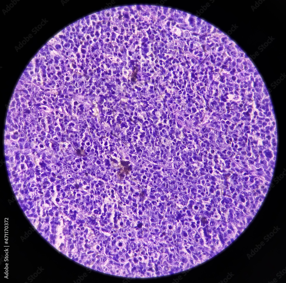 Foto de Stock Inguinal lymph node: Non-Hodgkin's lymphoma,high grade ...