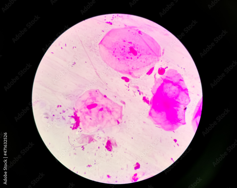 HVS Gram stain: Gram positive cocci, Gram positive diplococci bacteria ...