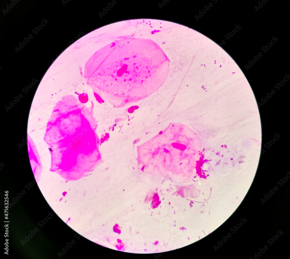 Prostatic smear for Gram Staining microscopic 100x show Neisseria ...