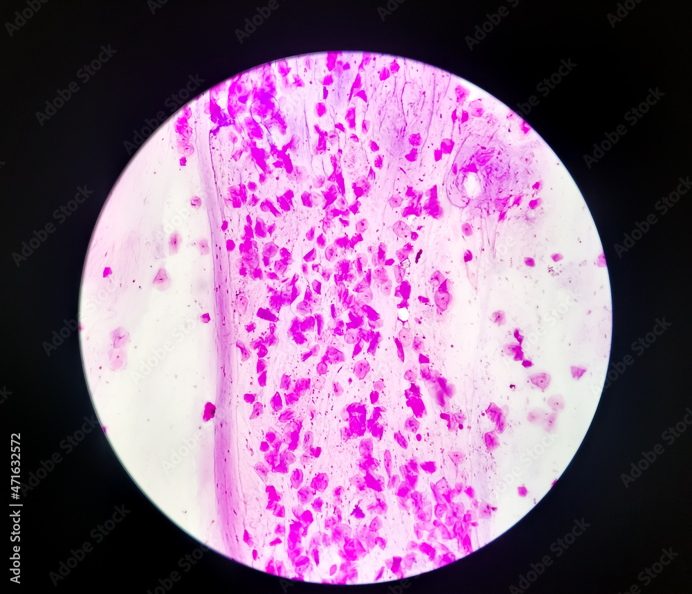 Gram stain: Gram positive cocci, Gram positive diplococci bacteria ...