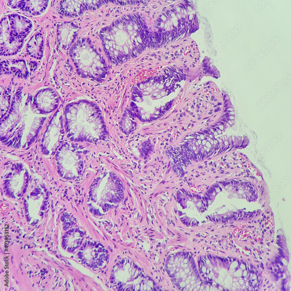 Camera photo of rectal mucosa in patient with solitary rectal ulcer ...