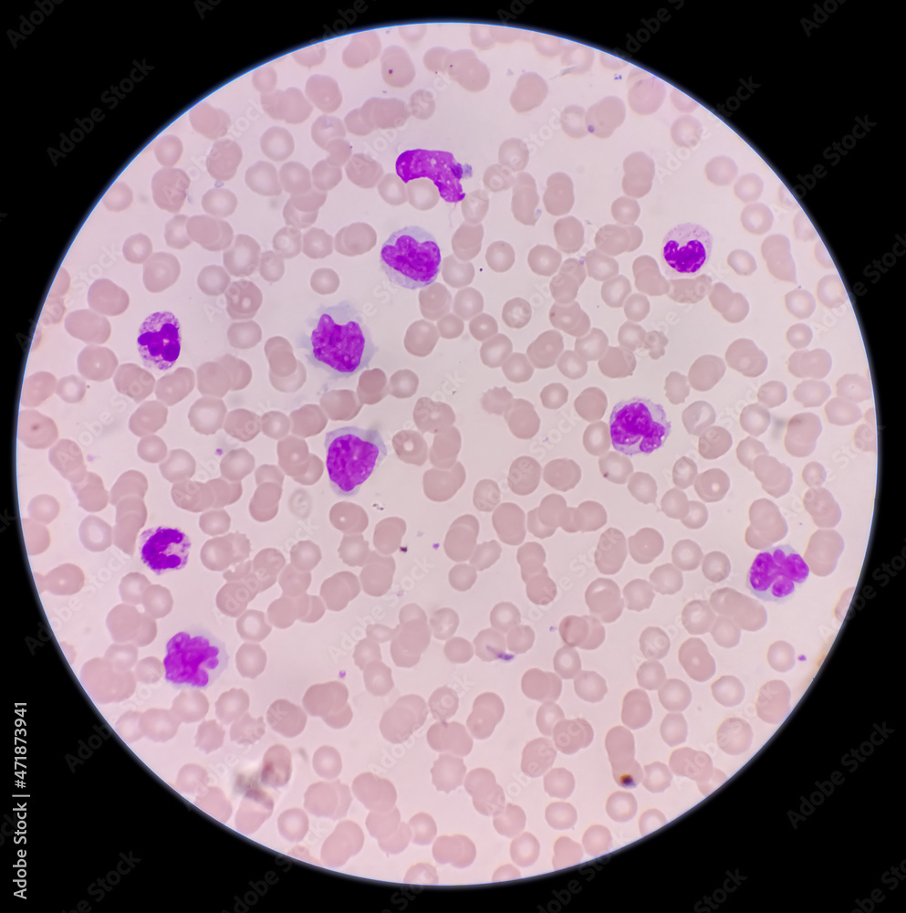 Microscopic image showing thrombocytopenia with leukocytosis, monocytes ...