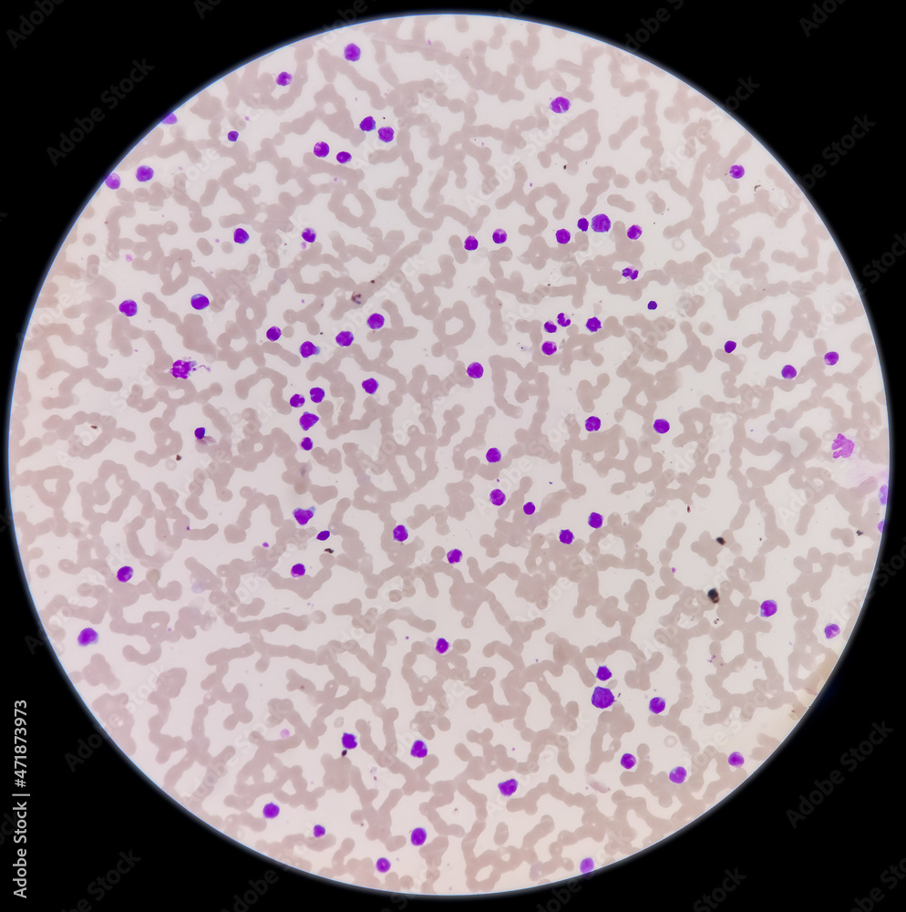 Microscopic image showing thrombocytopenia with leukocytosis, monocytes ...