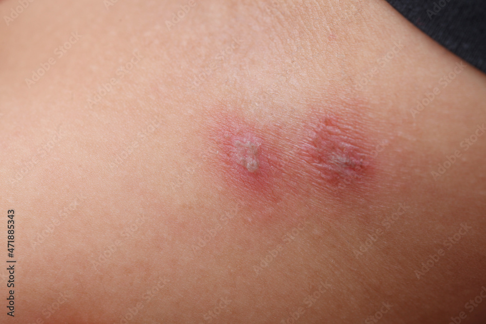 Shingles (Disease), Herpes zoster, varicella-zoster virus. skin rash ...