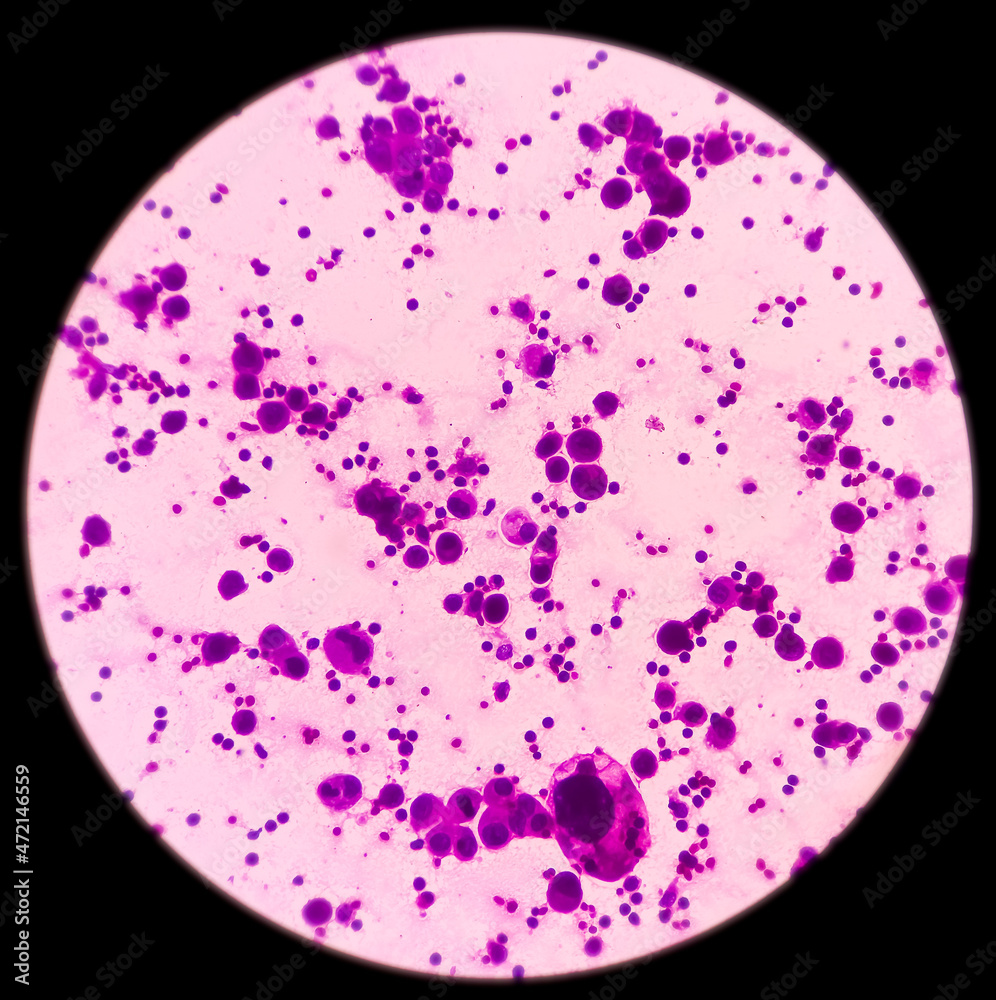 Malignant cells(cancer cells): Pleural fluid cytology of lung ...
