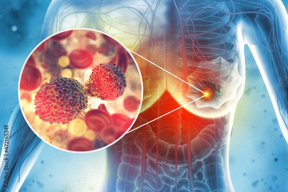 Breast cancer.Female breast anatomy Stock Illustration | Adobe Stock