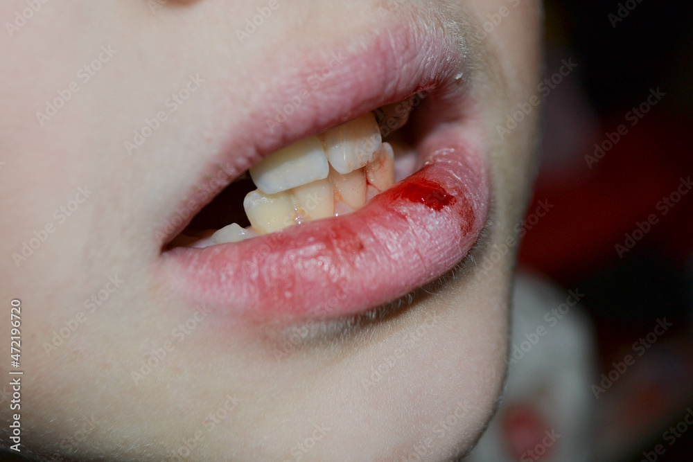 Dry and damaged lips of a girl. Close-up. Lip fissure and bleeding. Sick cracked damaged tissue ...